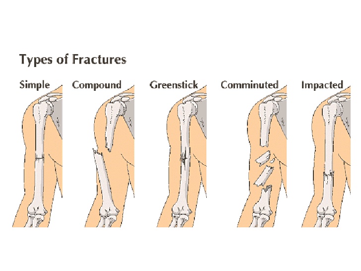 Types Of Fractures Worksheet Types Of Fractures Worksheet